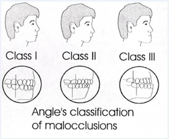 Online Orthodontics – What's in Your Mouth?