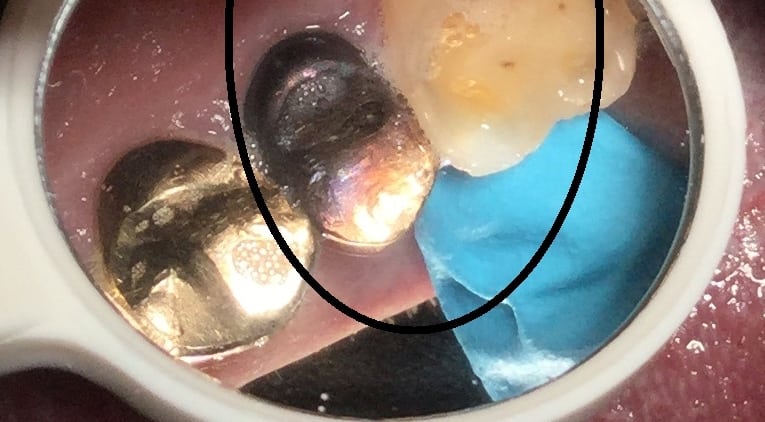 Galvanic Corrosion and Tarnish in vivo – What's in Your Mouth?