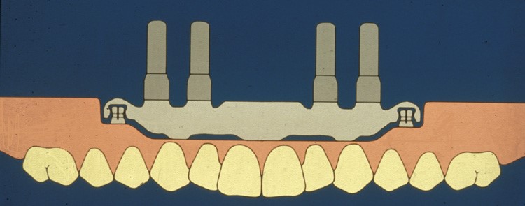 Attachment Considerations, Options and Selection Part I – What's in ...