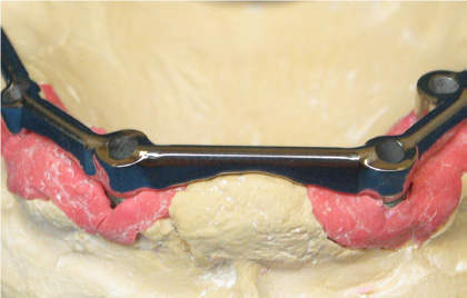 Attachment Considerations, Options and Selection Part II – What's in ...