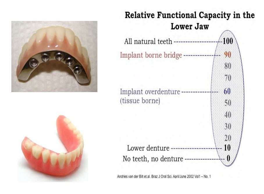 Hybrid Denture Protocol and Procedures for Successful Case Outcome ...