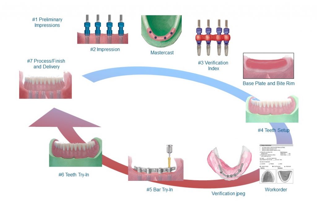 Hybrid Denture Protocol and Procedures for Successful Case Outcome ...