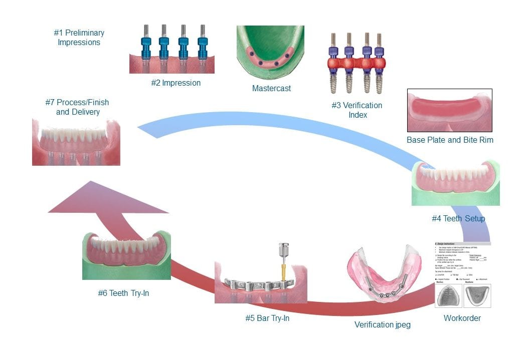 Hybrid Denture Protocol and Procedures for Successful Case Outcome ...