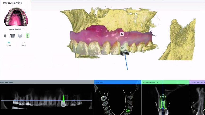 Digital Impressions – What's in Your Mouth?