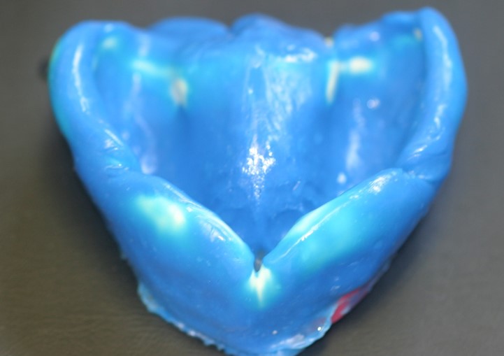 Digital vs. Analog in Removable Technology – What's in Your Mouth?