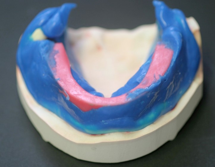 Digital vs. Analog in Removable Technology – What's in Your Mouth?
