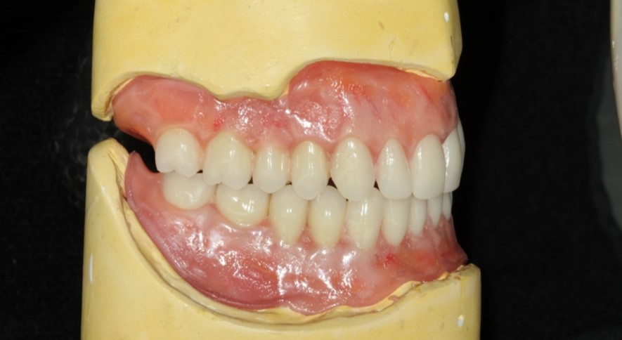 Digital vs. Analog in Removable Technology – What's in Your Mouth?
