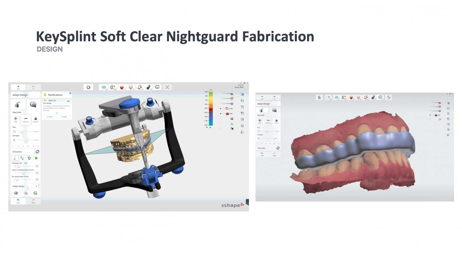 3D Printed Night Guards with KeySplint Soft Resin; The Game Changer for ...