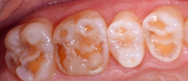 All-Ceramic Single-Tooth Restorations for Treating Damaged Dental ...