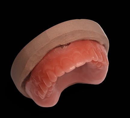 The Wax Duplicate Denture Technique: A Guide for Replication Accuracy ...