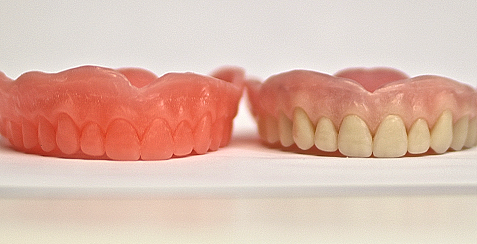 The Wax Duplicate Denture Technique: A Guide for Replication Accuracy ...