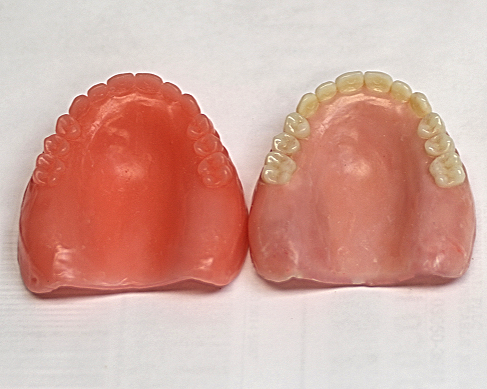 The Wax Duplicate Denture Technique: A Guide for Replication Accuracy ...