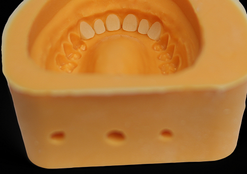 The Wax Duplicate Denture Technique: A Guide for Replication Accuracy ...
