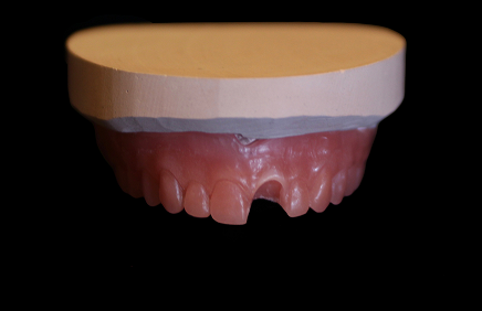 The Wax Duplicate Denture Technique: A Guide for Replication Accuracy ...
