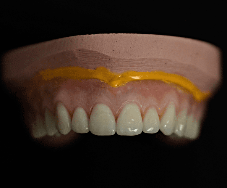 The Wax Duplicate Denture Technique: A Guide for Replication Accuracy ...