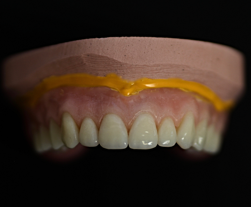 The Wax Duplicate Denture Technique: A Guide for Replication Accuracy ...