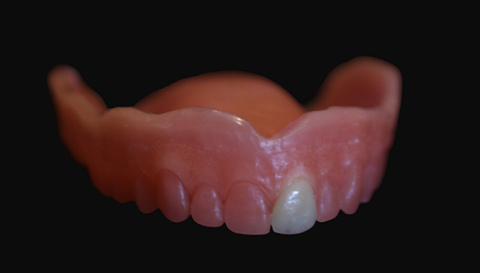 The Wax Duplicate Denture Technique: A Guide for Replication Accuracy ...