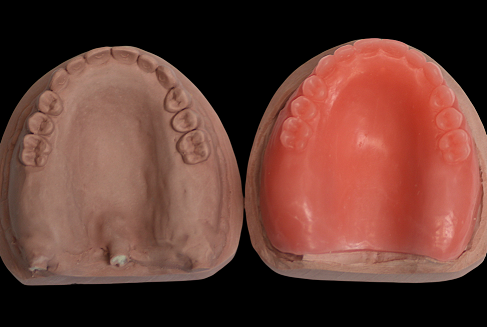 The Wax Duplicate Denture Technique: A Guide for Replication Accuracy ...