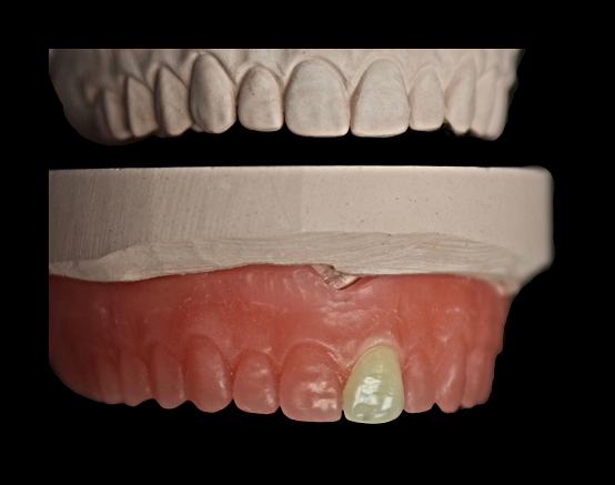 The Wax Duplicate Denture Technique: A Guide for Replication Accuracy ...