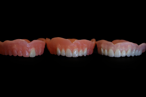 The Wax Duplicate Denture Technique: A Guide for Replication Accuracy ...