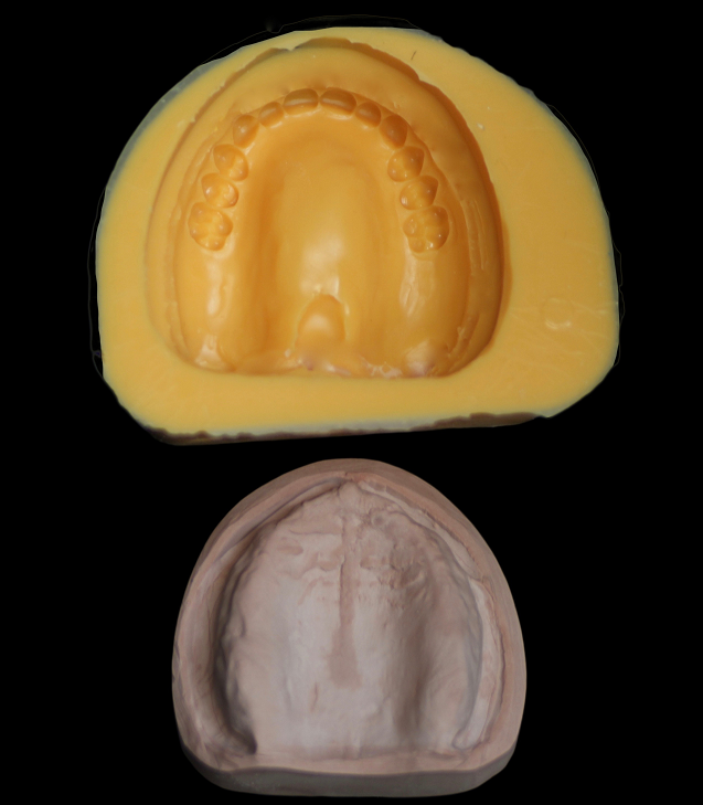 The Wax Duplicate Denture Technique: A Guide for Replication Accuracy ...