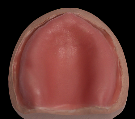 The Wax Duplicate Denture Technique: A Guide for Replication Accuracy ...