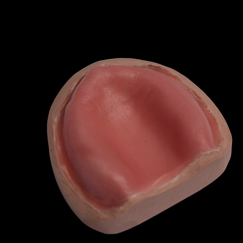 The Wax Duplicate Denture Technique: A Guide for Replication Accuracy ...