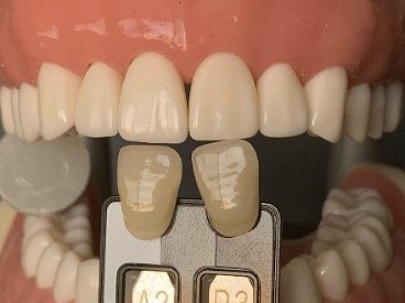Mapping a New Course to Shade Determination – What's in Your Mouth?