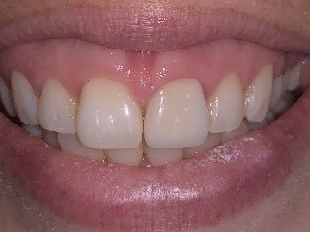 Mapping a New Course to Shade Determination – What's in Your Mouth?