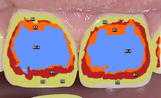 Mapping a New Course to Shade Determination – What's in Your Mouth?