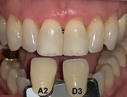 Mapping a New Course to Shade Determination – What's in Your Mouth?