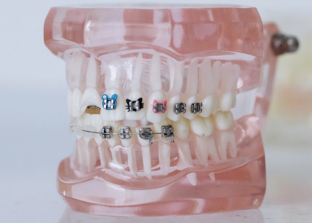 Making Braces Fun for Your Kids – What's in Your Mouth?