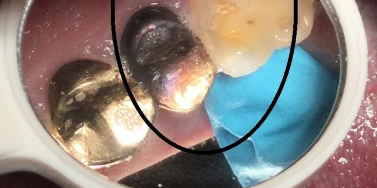 Galvanic Corrosion and Tarnish in vivo – What's in Your Mouth?